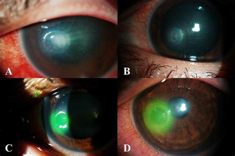 Ab Conjunctival Hyperaemia And Annular Infiltration With Radial