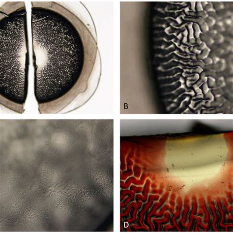 A Wave Like Calcification Of The Posterior Surface Of Bil B Detailed Download Scientific