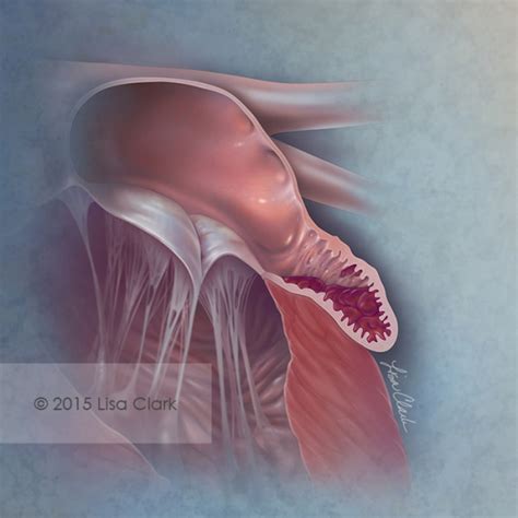Left Atrial Appendage Thrombus Artists Blogs Medical Illustration