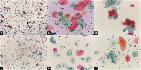 Application Of Cytopath®easy Vials In Cervical Cancer Screening Self