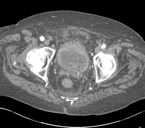 Infiltrating Transitional Cell Cancer Tcc Of The Bladder