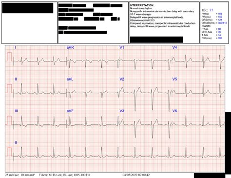 Ecg Results Active 30 Year Old With Nonspecific Intraventricular Conduction Delay R