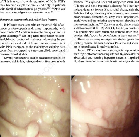 Multiple Fundic Gland Polyps In Two Patients During Long Term Therapy Download Scientific