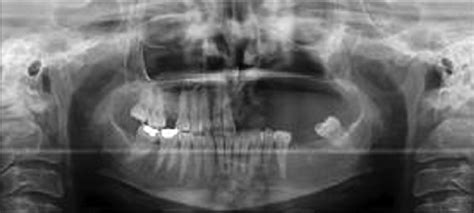 10 Years Follow Up Panorex Radiograph Download Scientific Diagram