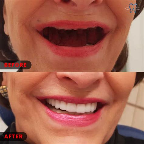 Dental Implants Near Me Permanent Tooth Replacement