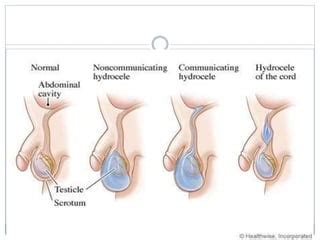 Hydrocele Pptx