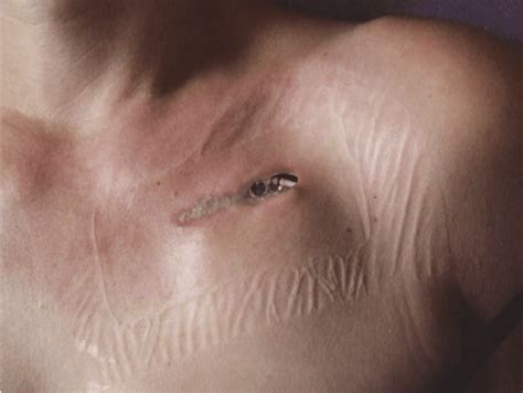 Pacemaker Basics Rebel Em Emergency Medicine Blog