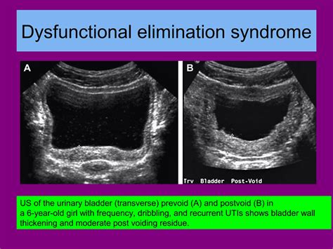 Pediatric Urinary Tract Infectionthe Role Of Imaging Ppt