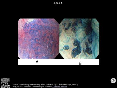 Chromoendoscopy And Magnifying Endoscopy For Barretts Esophagus Ppt Download