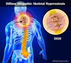 Diffuse Idiopathic Skeletal Hyperostosis Dish