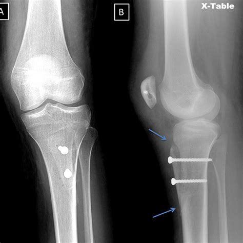 Pdf An Algorithmic Approach To The Management Of Recurrent Lateral