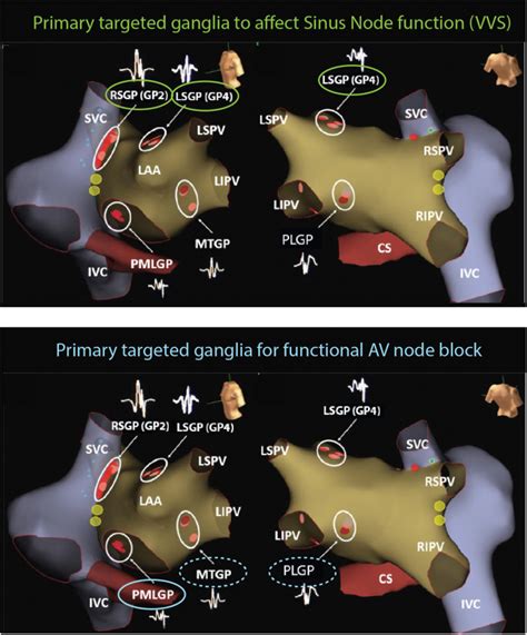Cardioneuroablation Where Are We At Pmc