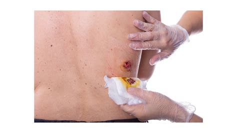 Dressing Selection For Chronic Wounds Addressing The Basics Woundsource