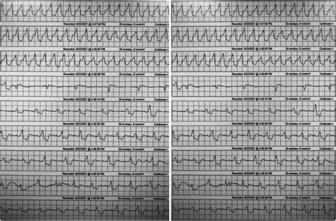 Diagnostic Odyssey From Arvc To Avnrt Shm Abstracts Society Of Hospital Medicine