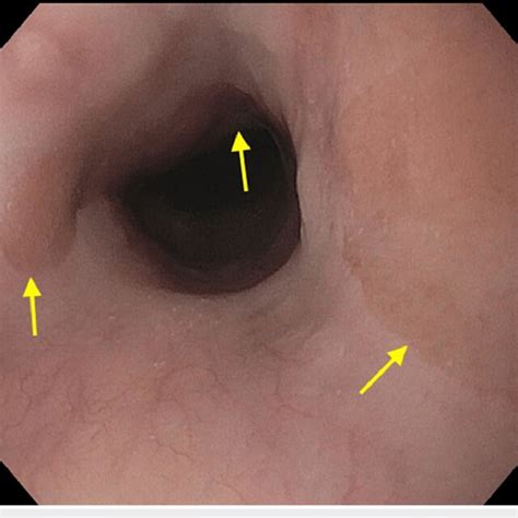 Upper Endoscopy Reveals Multiple Salmon Colored Mucosae In The Upper