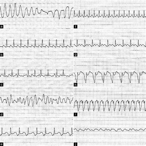 Drugs Prolonging Qtc Interval Download Table