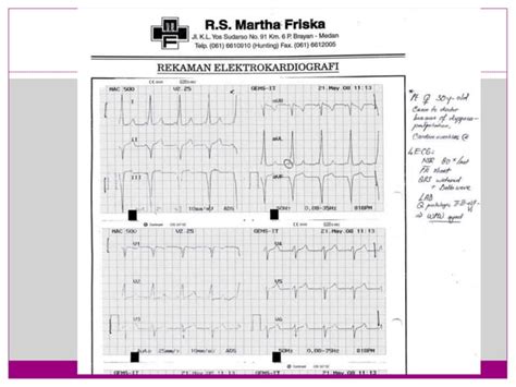 Basic Of Pre Excitation Syndrome PPTX