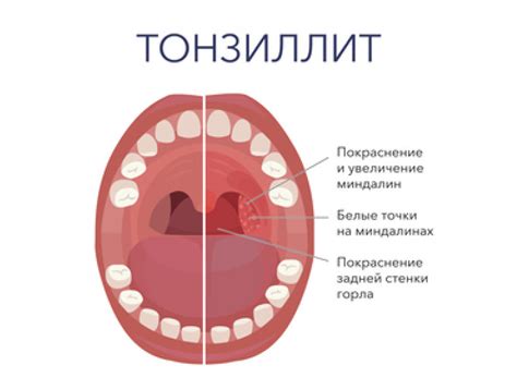 Тонзиліт | Симптоми | Діагностика | Лікування - Lik.ua