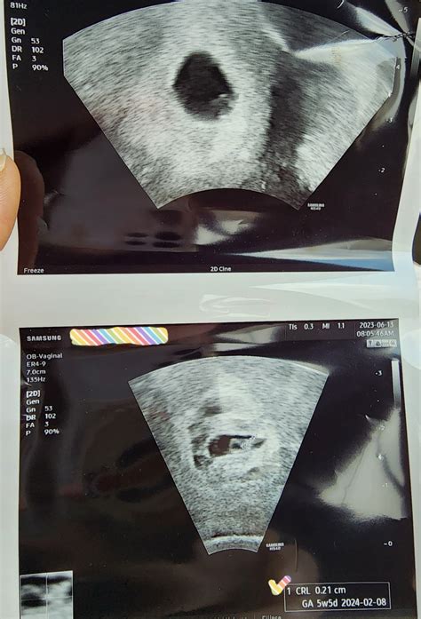 시험관6주1일 심장소리 못들어 너무 걱정돼요ㅜ 임신질문 마미톡 커뮤니티