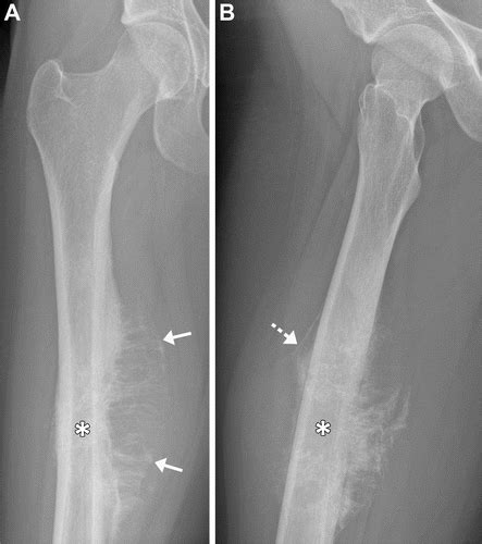 X Ray Osteosarcoma Arrow Aliemu