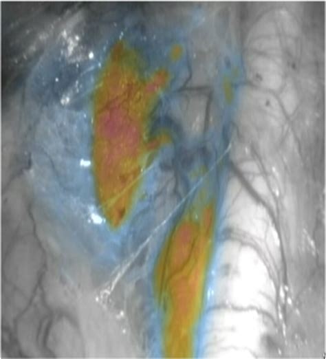 Sentinel Lymph Node Mapping In Minimally Invasive Surgery Role Of Imaging With Color Segmented