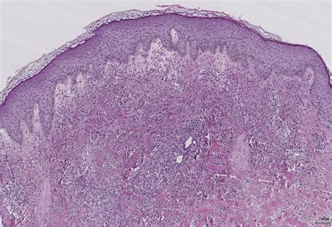 Chronic Recurrent Annular Neutrophilic Dermatosis Revealing Sarcoidosis