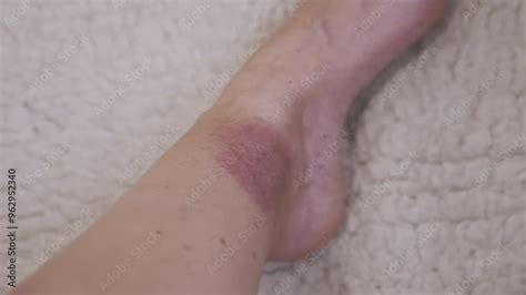 Close Up Formation Of A Large Red Spot On The Skin From A Tick Bite Irritation Itching