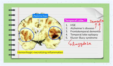 Medicine Memory And Emotions Are Functions Of Temporal Lobe