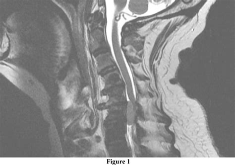 Intradural Extramedullary Spinal Metastasis From Prostate Carcinoma A Case Report Semantic