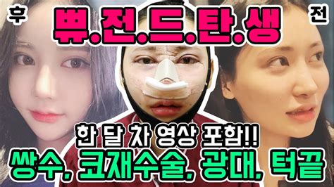 쎈언니 이미지 성형 Full영상 안면윤곽 And 코성형재수술 And 쌍수 뒷트임 과연 그 결과는 수술 직후부터 심상치 않다 🍪쿠키영상1개 포함🍪 쀼