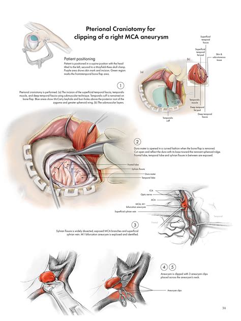 Pterional Craniotomy For Clipping A Mca Aneurysm Behance