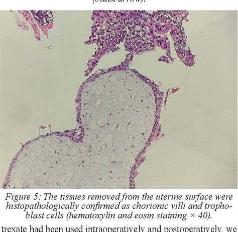 Figure 1 From Severe Intra Abdominal Hemorrhage Caused By Invasion Of