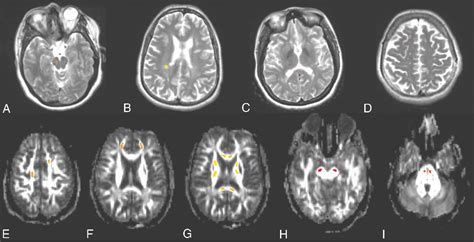 Figure 1 From Years Using Diffusion Tensor Imaging Measuring Brain Tissue Integrity During 4