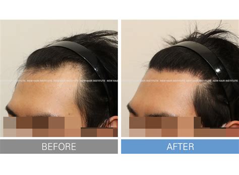 M자 이마 앞머리갈라짐 재수술 모발이식 전후 사진 모음