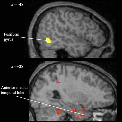 Figure 2 From Fmri Correlates Of The Episodic Retrieval Of Emotional Contexts Semantic Scholar