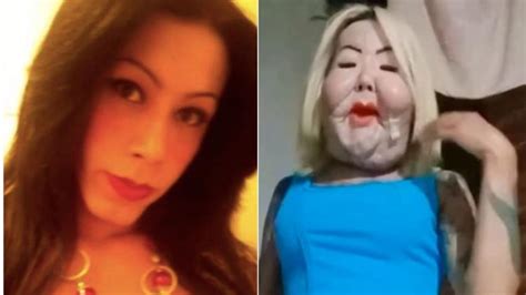 Juju Do Pix Revela O Rosto Após Cirurgia Para Remover óleo Mineral