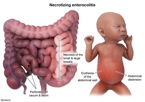Necrotizing Enterocolitis Abdomen