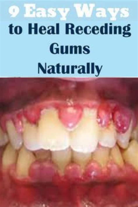 Fix Receding Gums And Remove Plaque And Tartar At Home Healthy Teeth