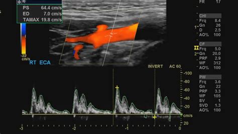Carotid Duplex Sonographic Tendencies