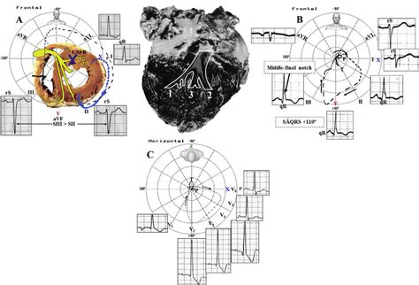 LAFB Fig A Causes Left Axis Deviation In The Frontal Plane Download Scientific Diagram