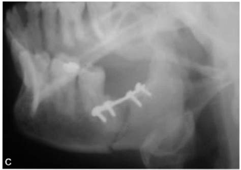 14 Ectopic Teeth And Unusual Cases Pocket Dentistry