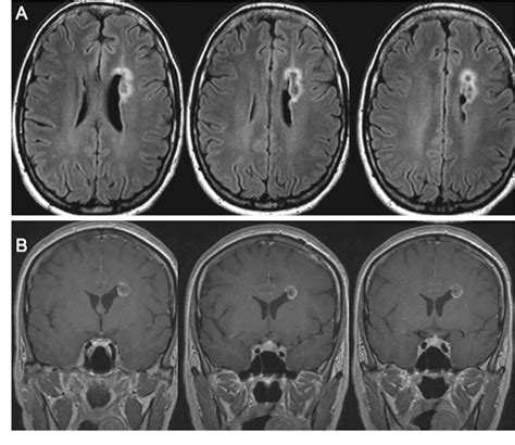 Periventricular Nodular Heterotopia Semantic Scholar