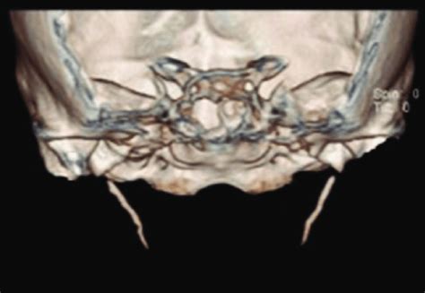 Elongated Styloid Process Three Dimensional Reconstruction Of Computed Download Scientific
