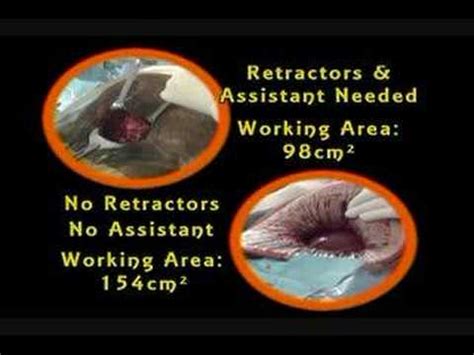 C Section With The Mobius Elastic Retractor Youtube