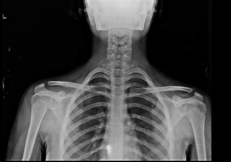 X Ray Teleradwin