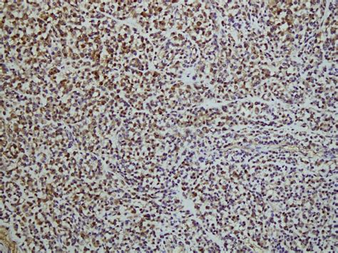 Pathology Outlines GIST