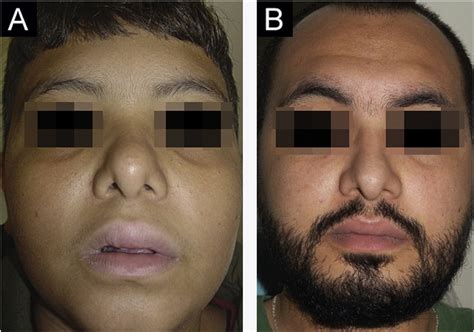 A Case 4 Diffuse Facial Edema B Same Patient As An Adult Download Scientific Diagram