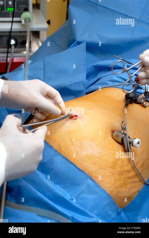 Gall Bladder Removal