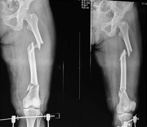 Plain Radiography Shows Multiple Fractures Of The Left Femur And Download Scientific Diagram