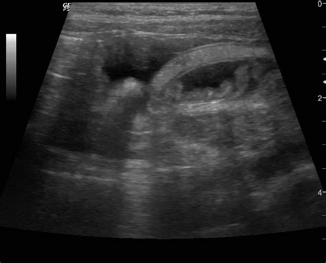 Ascariasis Causes Symptoms And Treatment